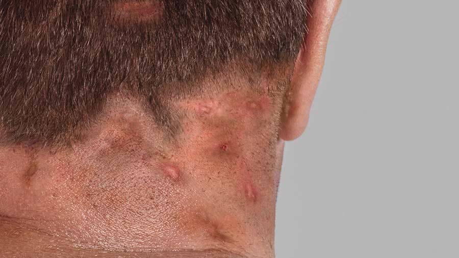 Hidradenitis Suppurativa (HS) Pictures | HUMIRA® (adalimumab)